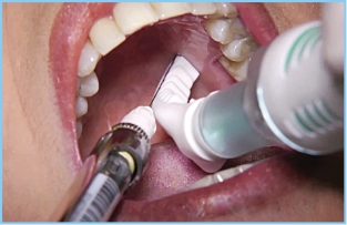 How to use the DentalVibe®. - Find A Dentist | DentalVibe | Anxiety ...