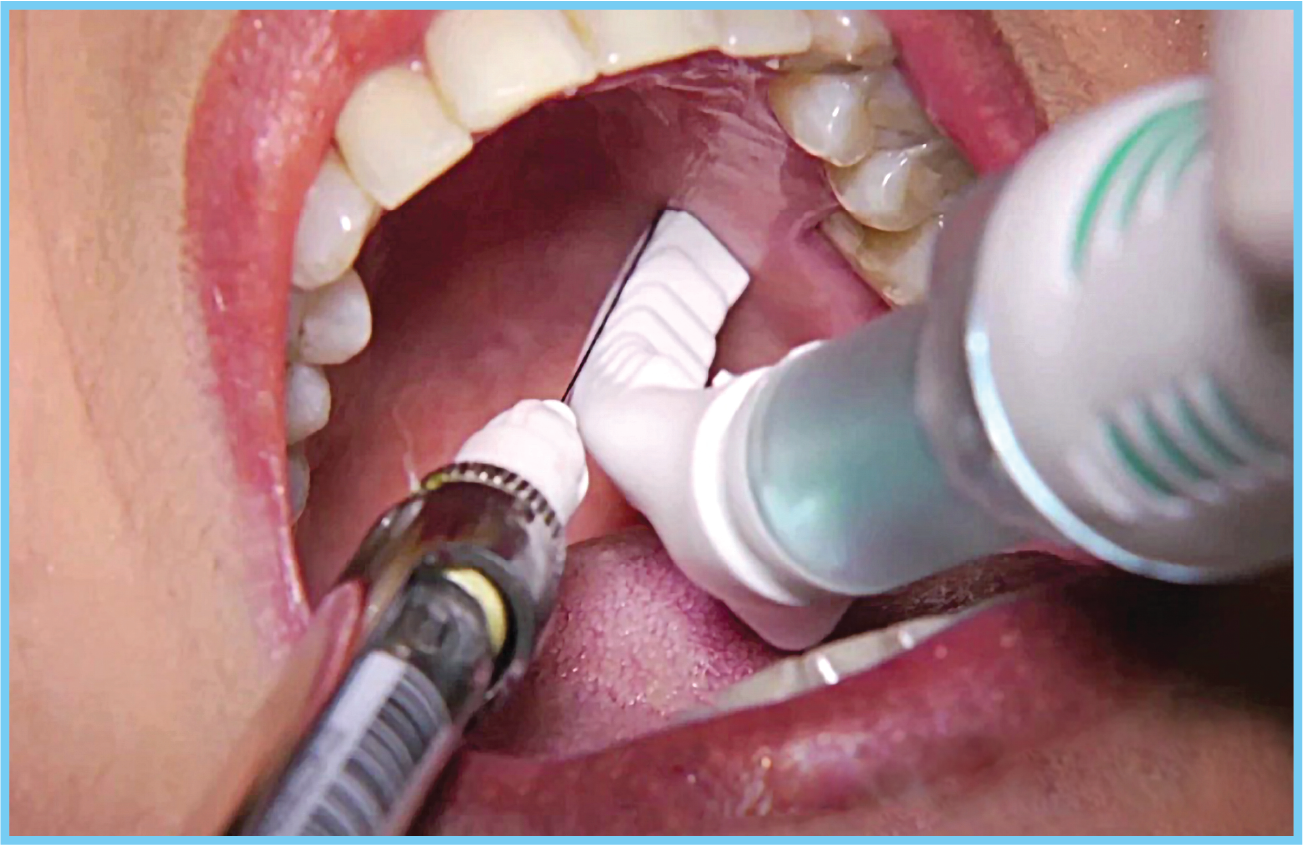 How to use the DentalVibe®. - Find A Dentist | DentalVibe | Anxiety ...